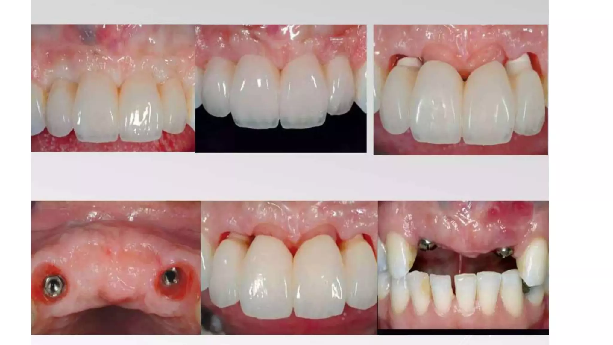 PONTICS IN FIXED PARTIAL DENTURE.pptx