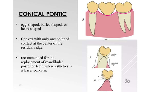 PONTICS IN FIXED PARTIAL DENTURE.pptx