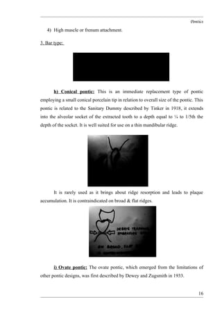 Pontics in fpd | DOC