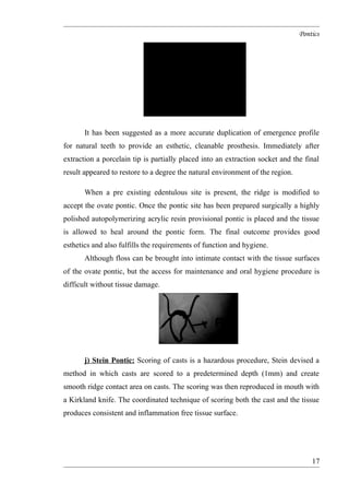 Pontics in fpd | DOC