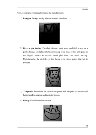 Pontics in fpd | DOC