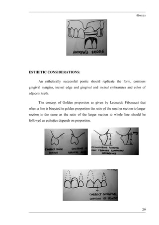 Pontics in fpd | DOC