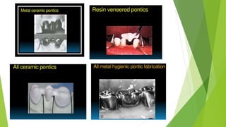 Pontics in fpd | PPTX