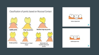 Pontics in fpd by Dr. Khirabdhi T Mishra | PPTX