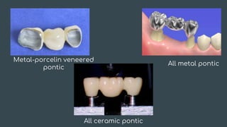 Pontics in fpd by Dr. Khirabdhi T Mishra | PPTX