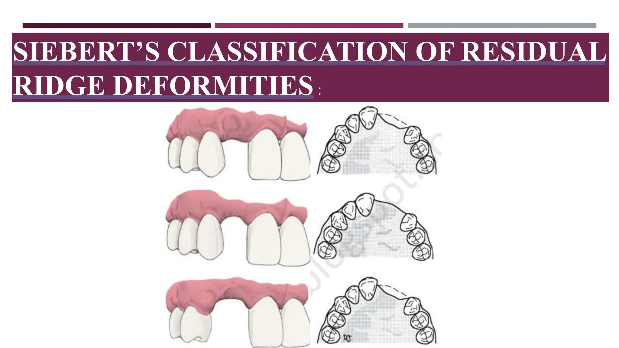 PONTICS IN Fixed partial denture - Prodthodontics.pptx | Dental Health ...