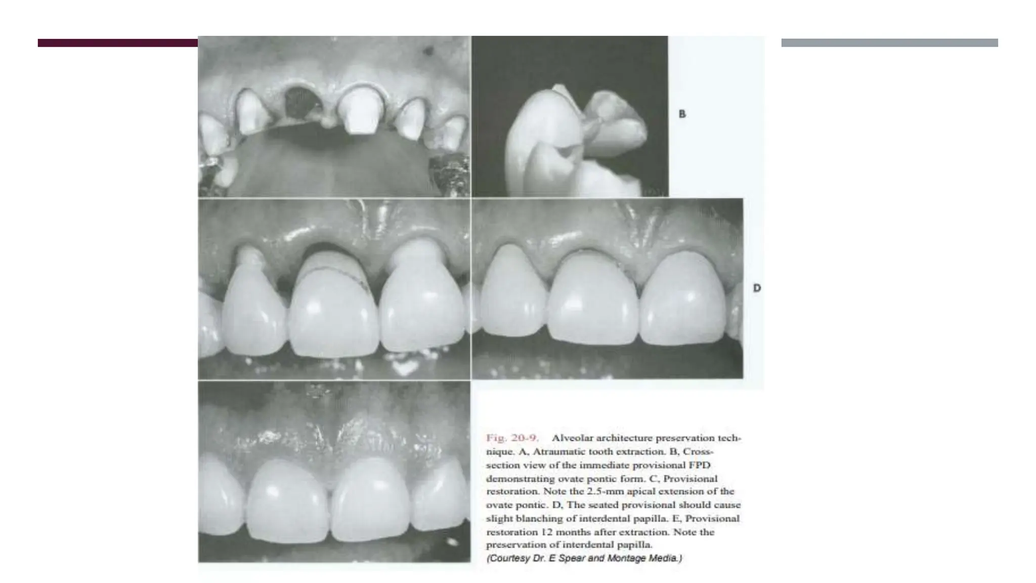 PONTICS IN Fixed partial denture - Prodthodontics.pptx