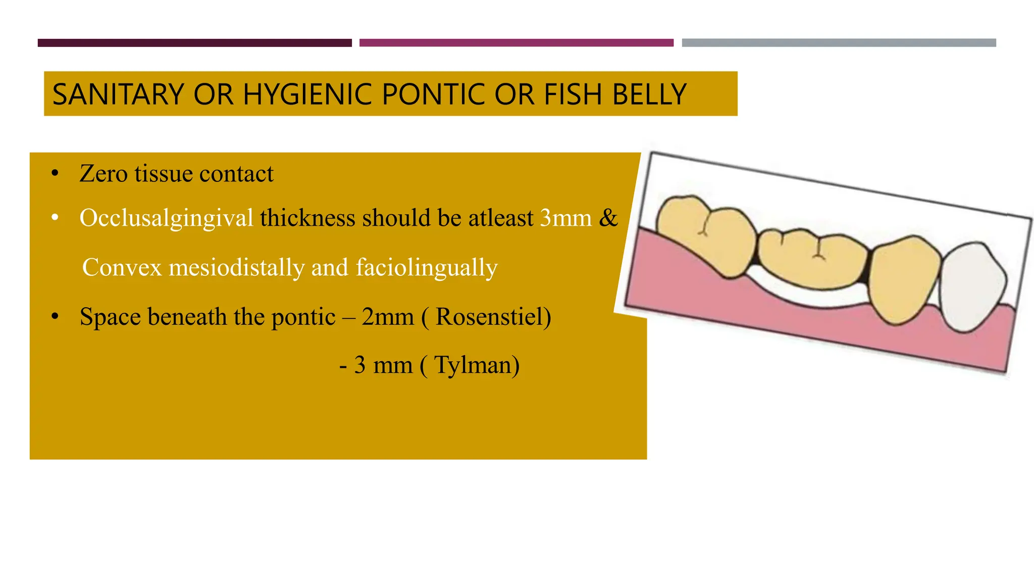 PONTICS IN Fixed partial denture - Prodthodontics.pptx