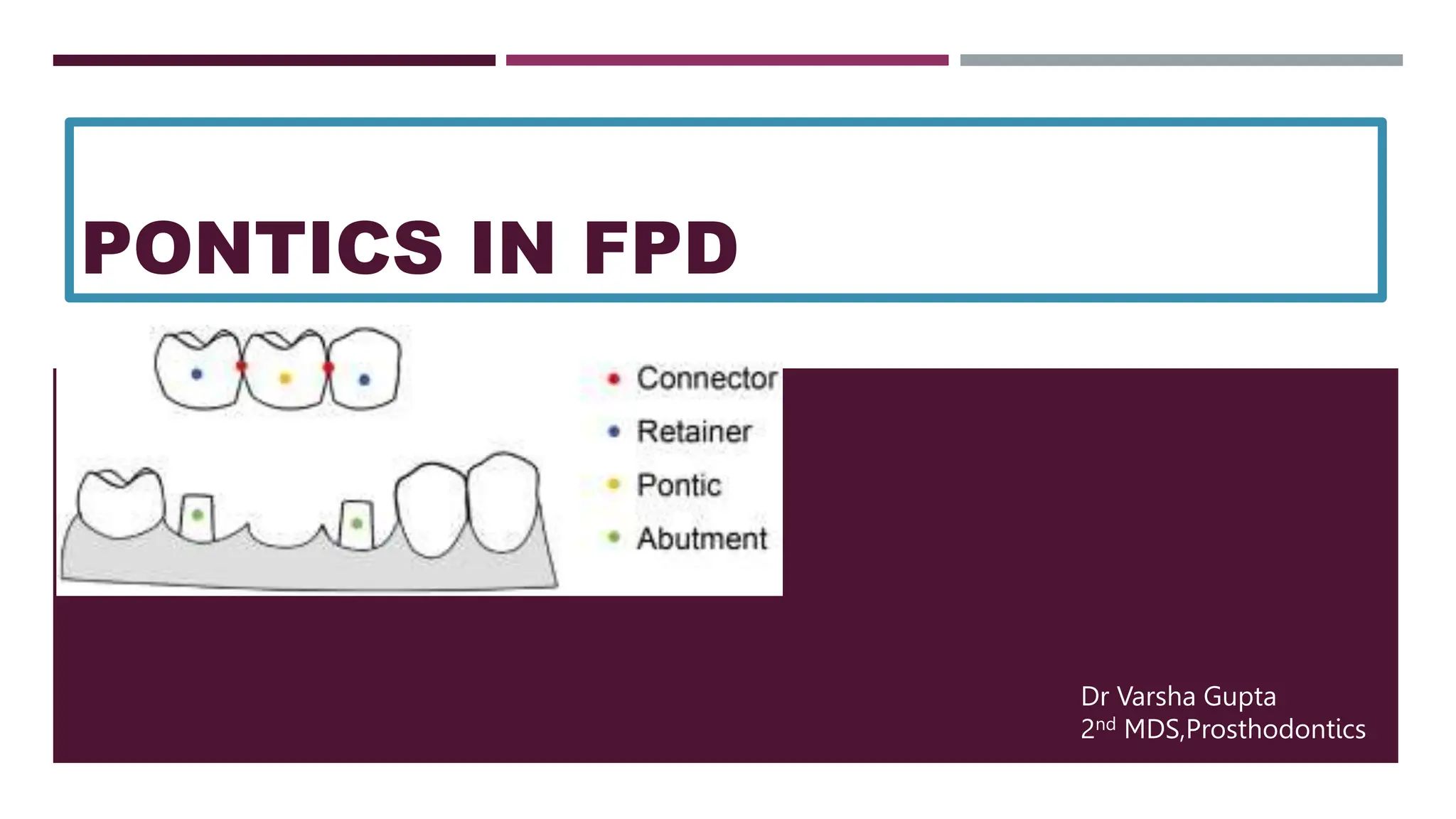 PONTICS IN Fixed partial denture - Prodthodontics.pptx