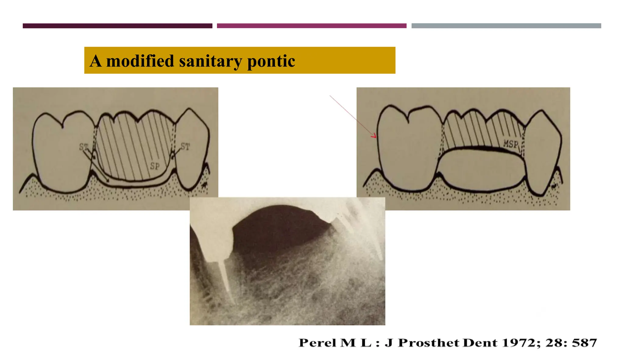 PONTICS IN Fixed partial denture - Prodthodontics.pptx
