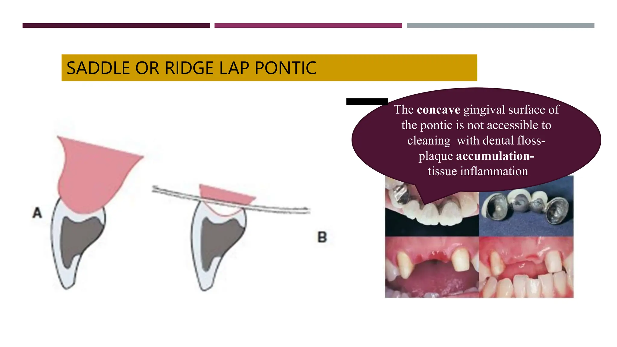 PONTICS IN Fixed partial denture - Prodthodontics.pptx