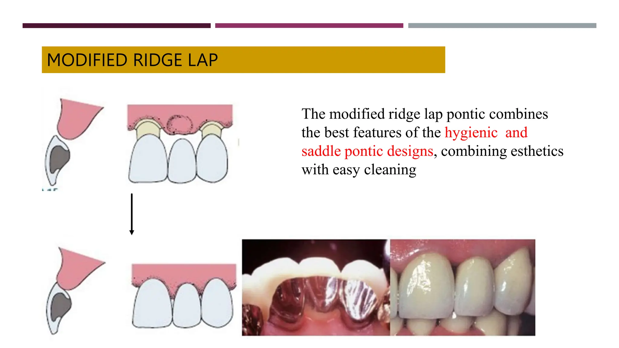 PONTICS IN Fixed partial denture - Prodthodontics.pptx