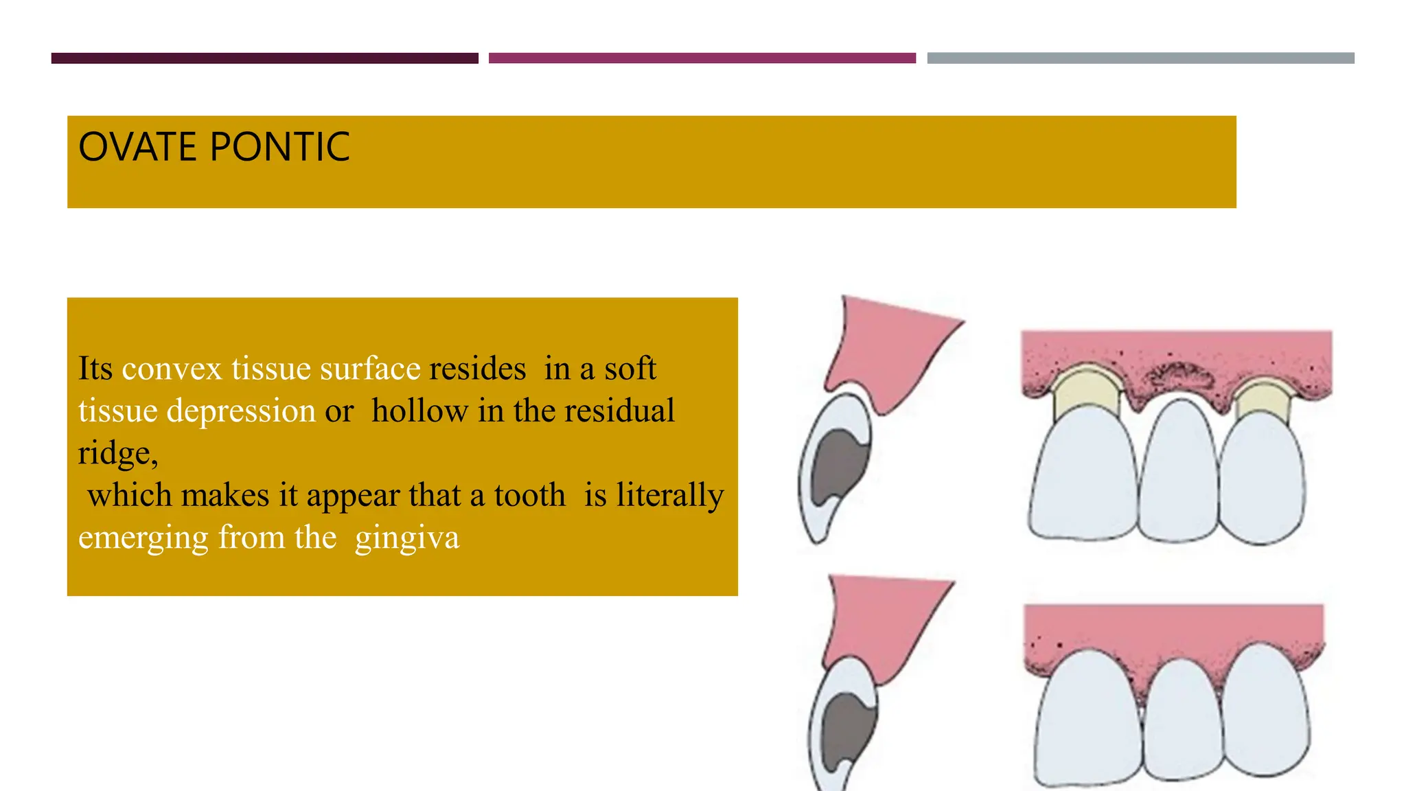 PONTICS IN Fixed partial denture - Prodthodontics.pptx