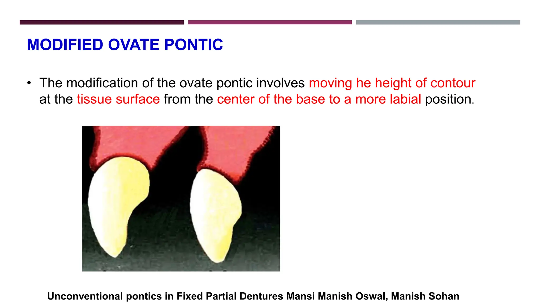 PONTICS IN Fixed partial denture - Prodthodontics.pptx