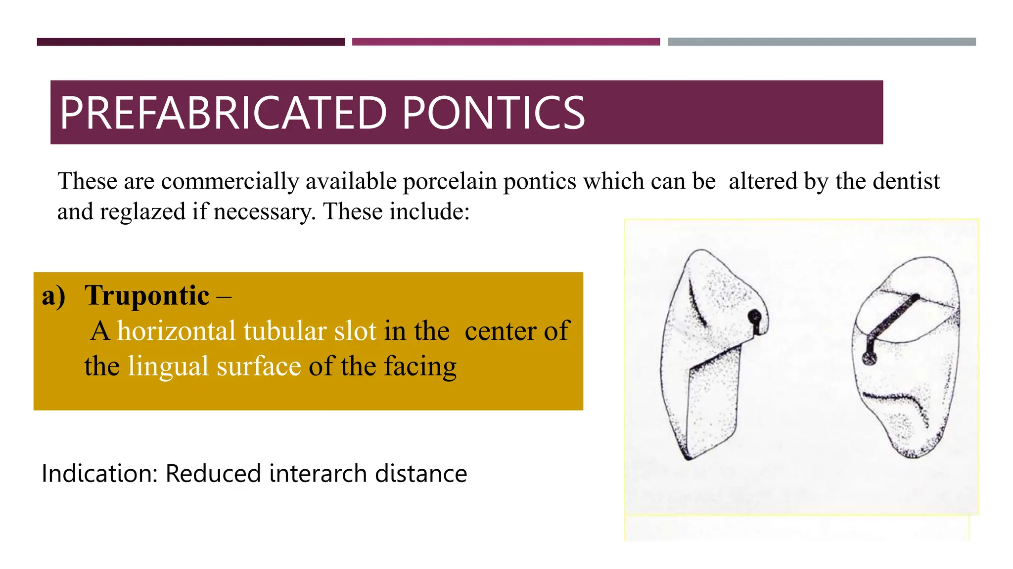 PONTICS IN Fixed partial denture - Prodthodontics.pptx