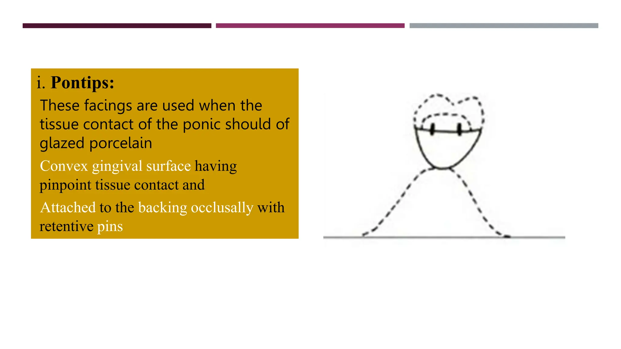 PONTICS IN Fixed partial denture - Prodthodontics.pptx