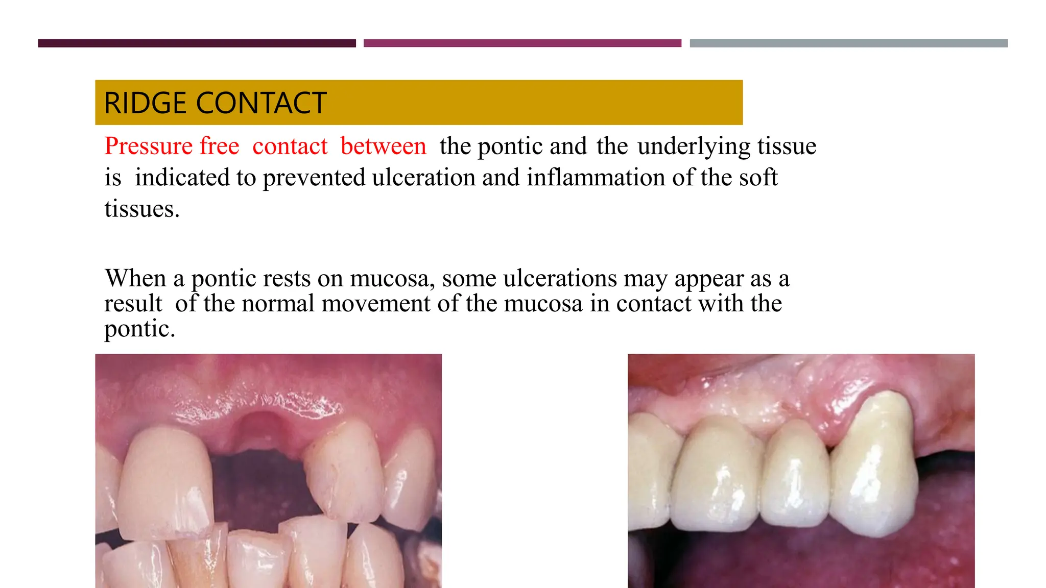 PONTICS IN Fixed partial denture - Prodthodontics.pptx