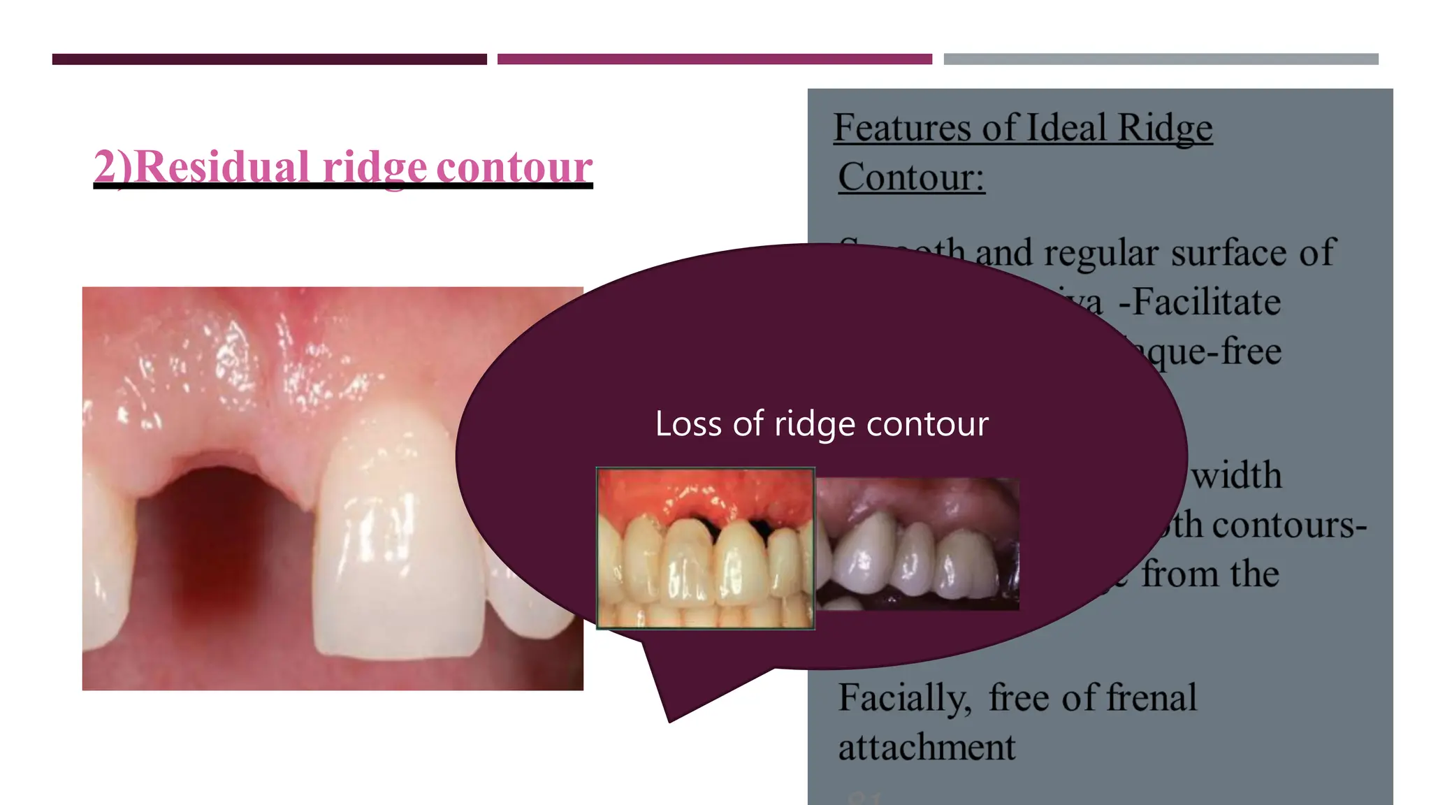 PONTICS IN Fixed partial denture - Prodthodontics.pptx