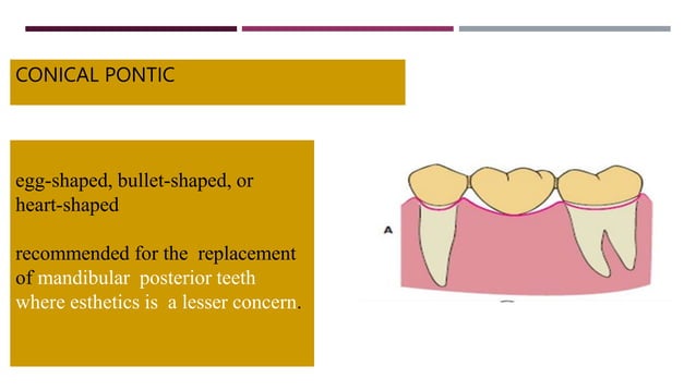 PONTICS IN Fixed partial denture - Prodthodontics.pptx | Dental Health ...