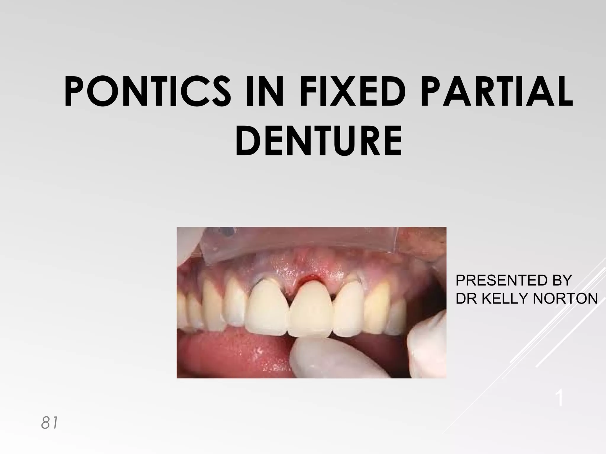 Pontics in Fixed Partial Dentures | PPT