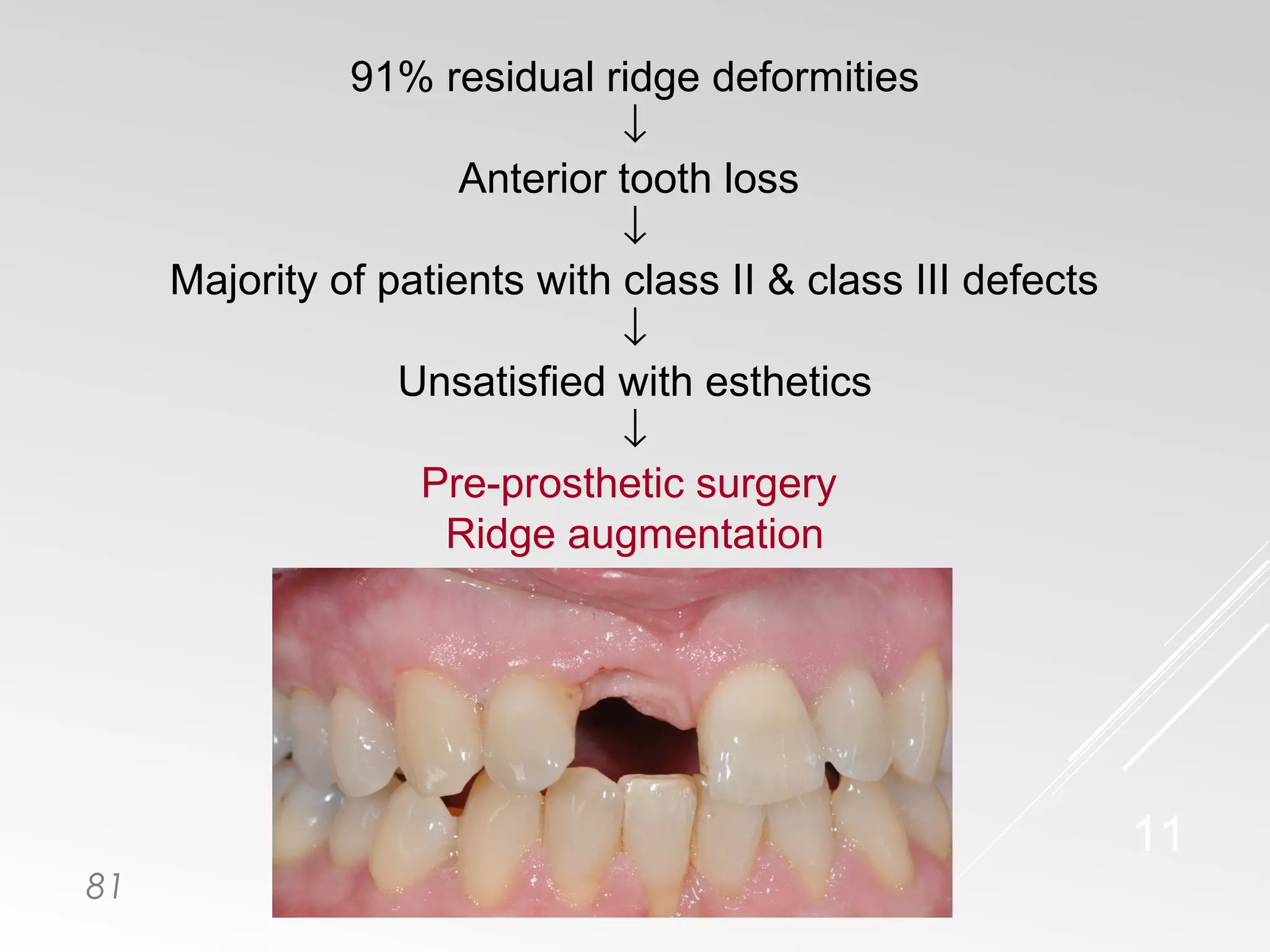 Pontics in Fixed Partial Dentures | PPT