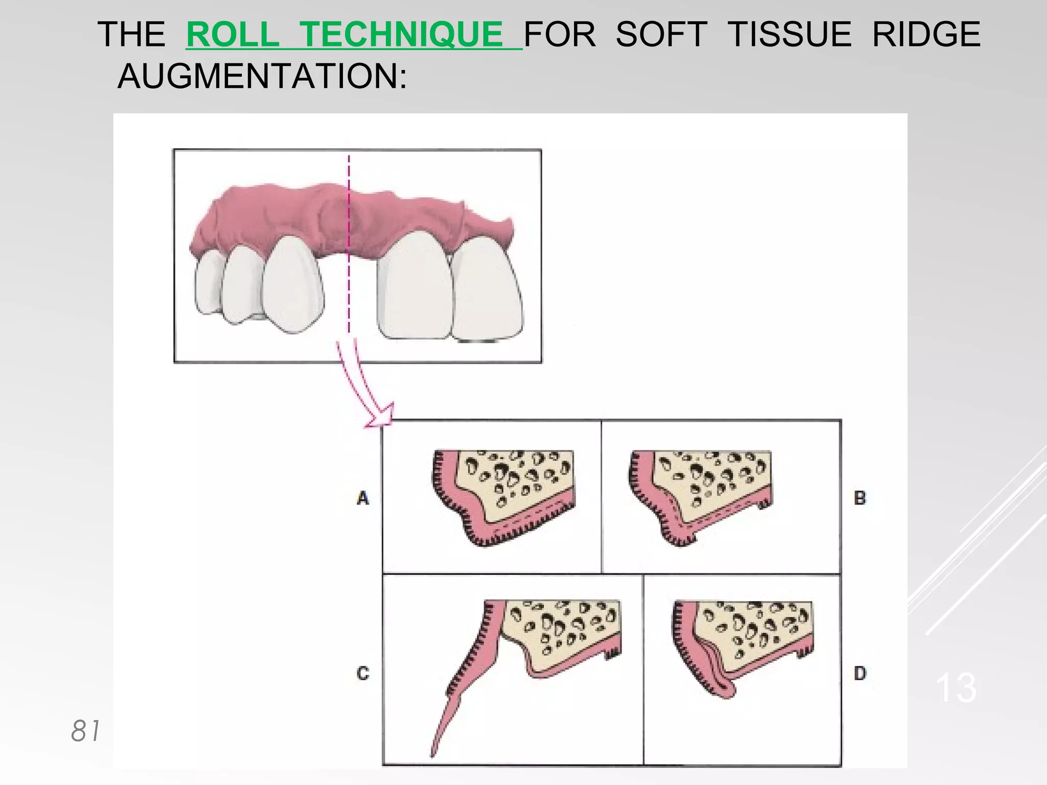 Pontics in Fixed Partial Dentures | PPT