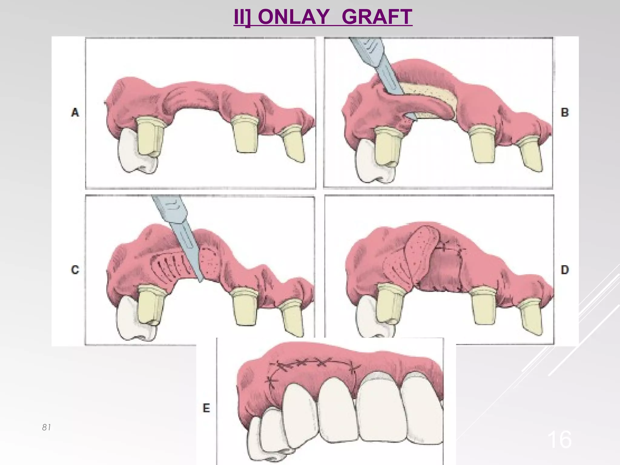 Pontics in Fixed Partial Dentures | PPT