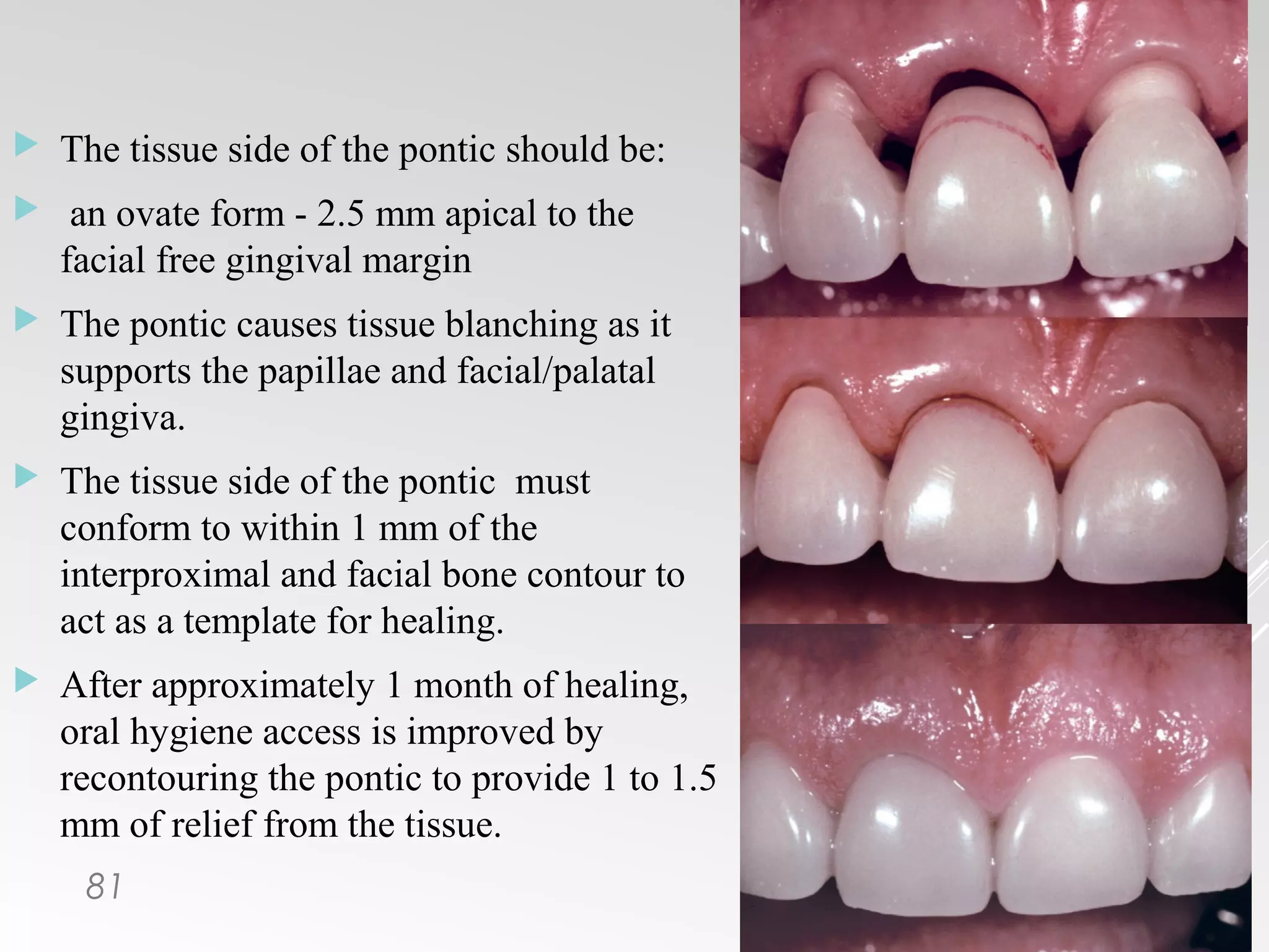 Pontics in Fixed Partial Dentures | PPT