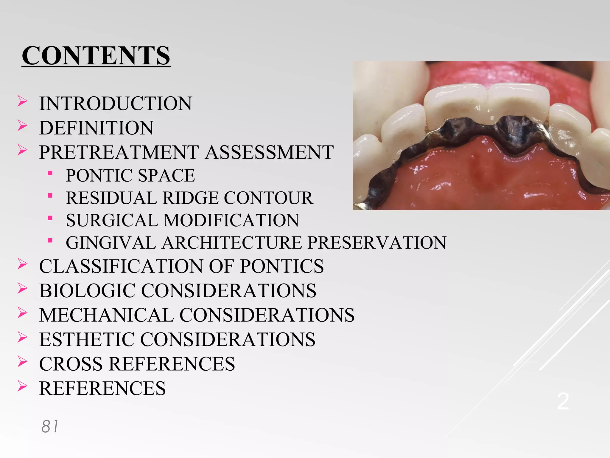 Pontics in Fixed Partial Dentures | PPT
