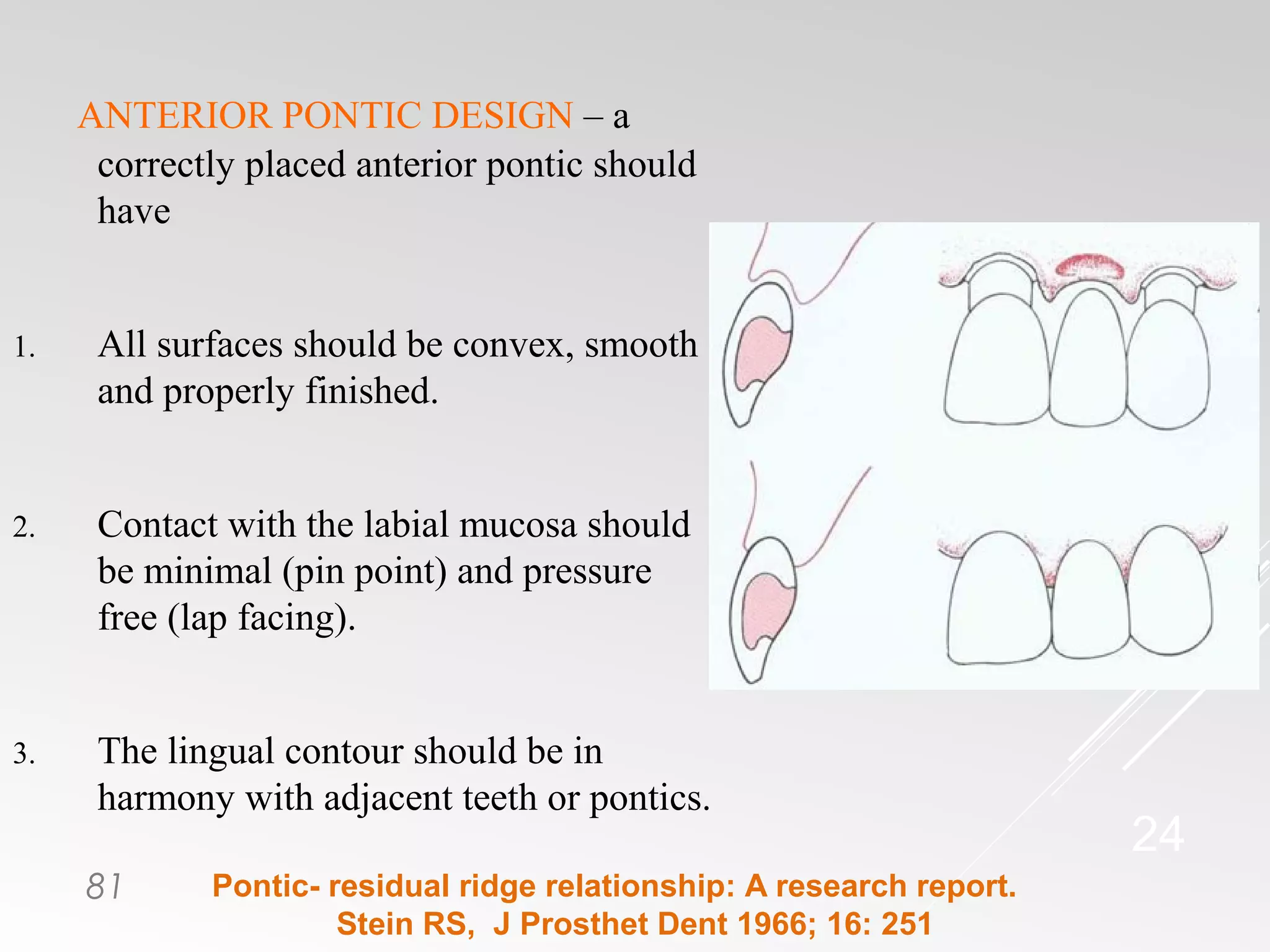 Pontics in Fixed Partial Dentures | PPT