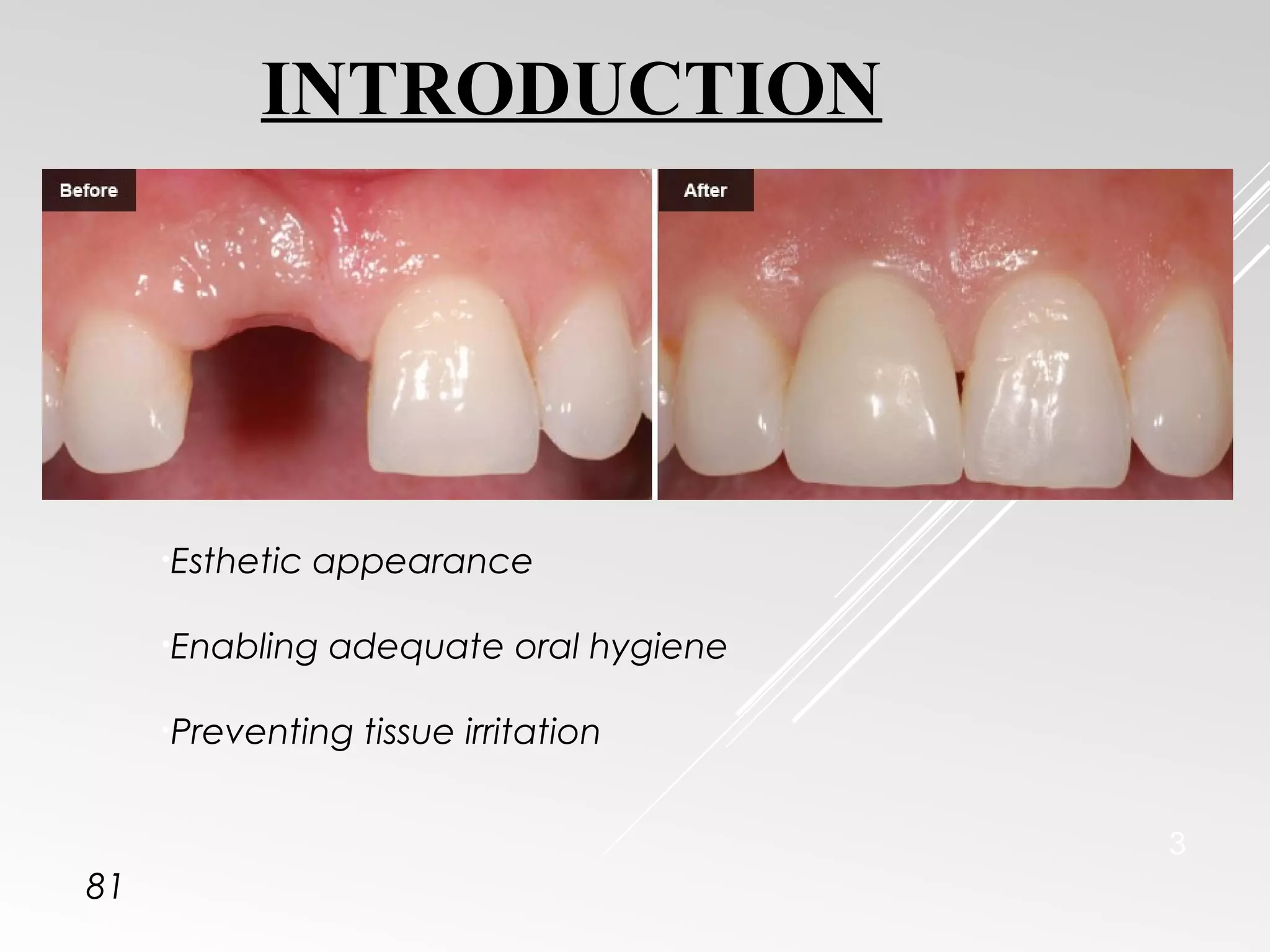 Pontics in Fixed Partial Dentures | PPT