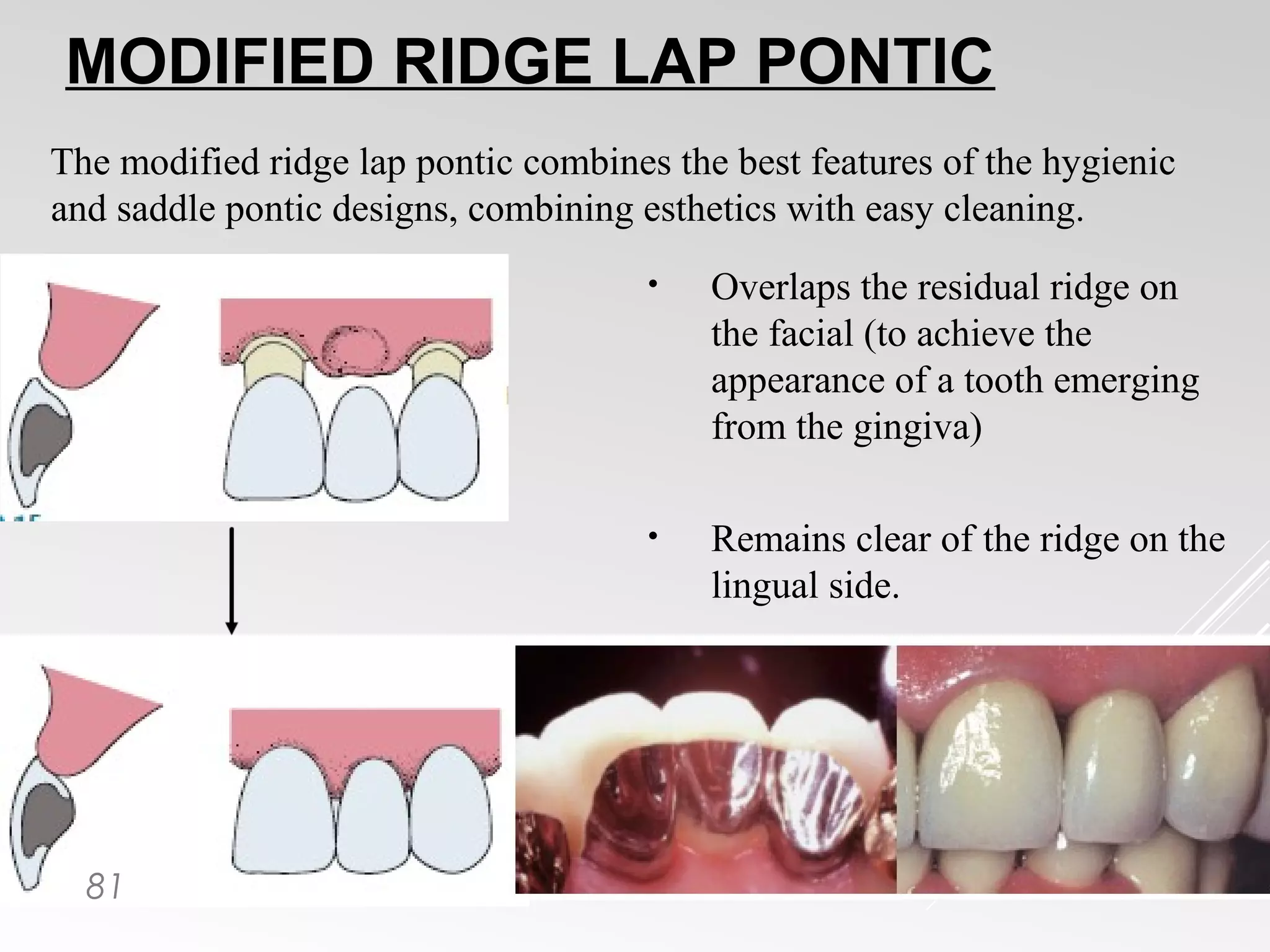 Pontics in Fixed Partial Dentures | PPT