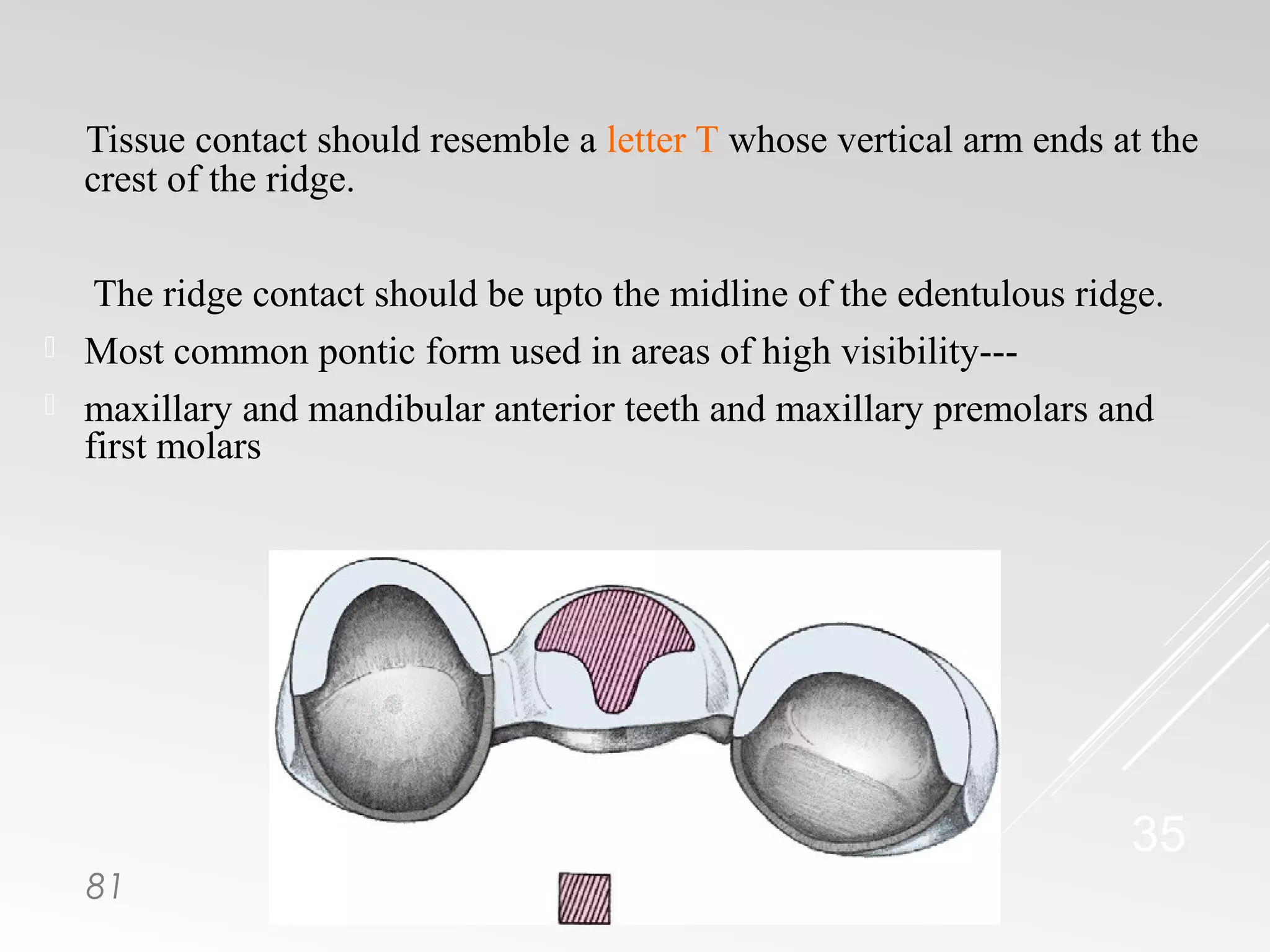 Pontics in Fixed Partial Dentures | PPT