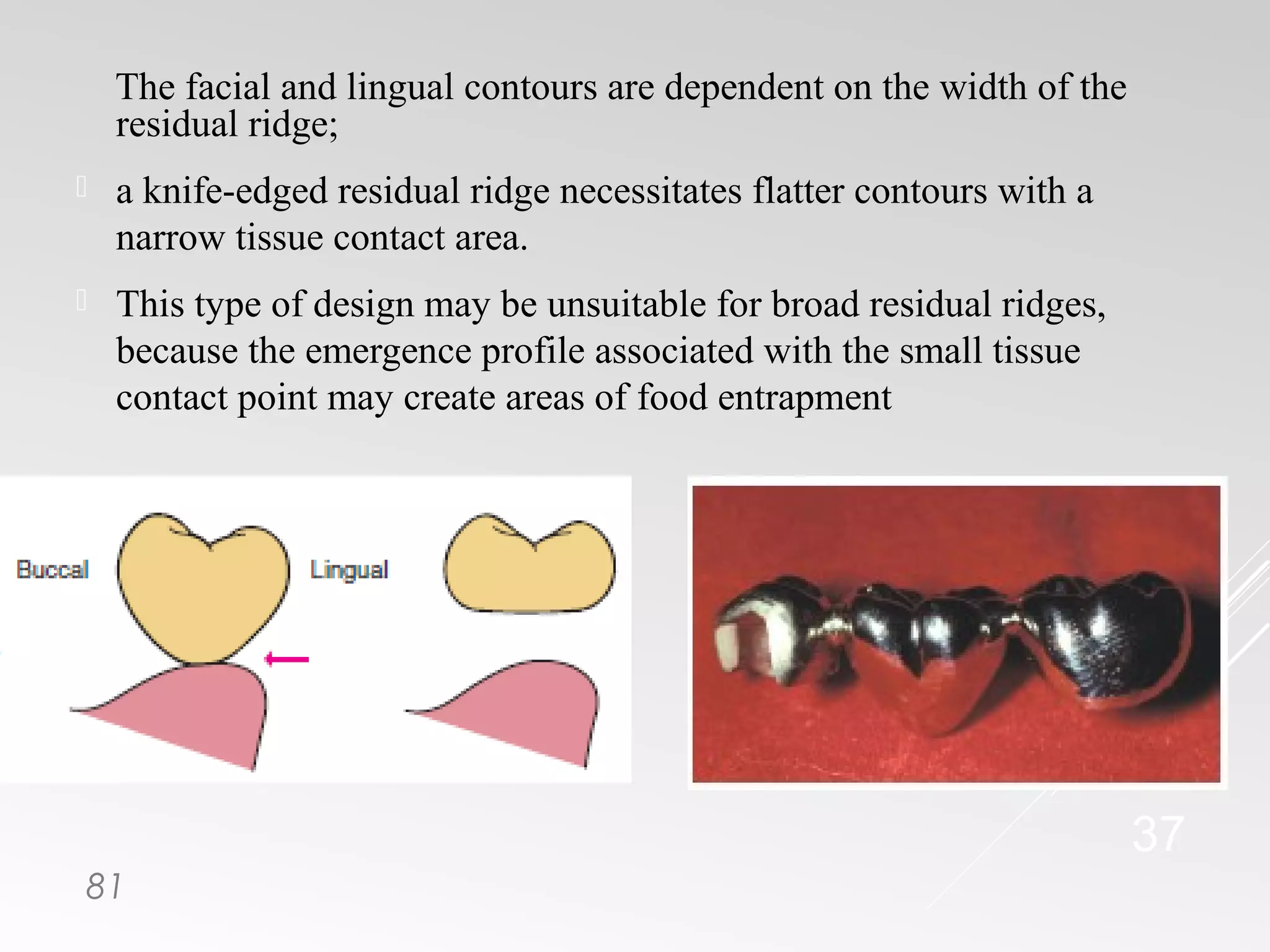 Pontics in Fixed Partial Dentures | PPT