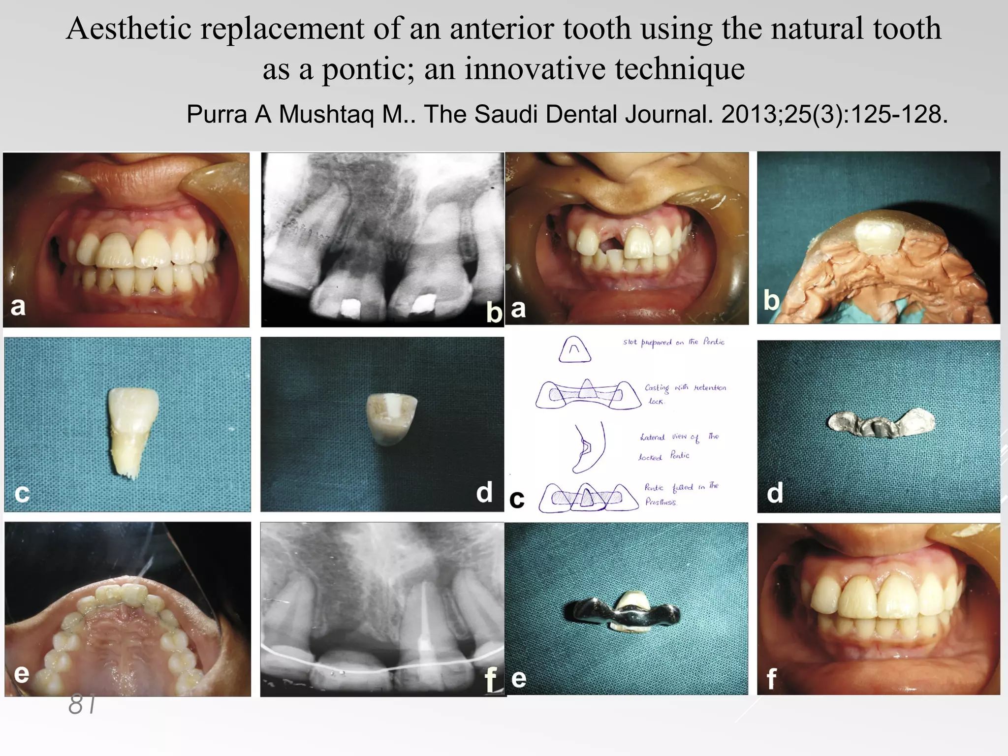 Pontics in Fixed Partial Dentures | PPT