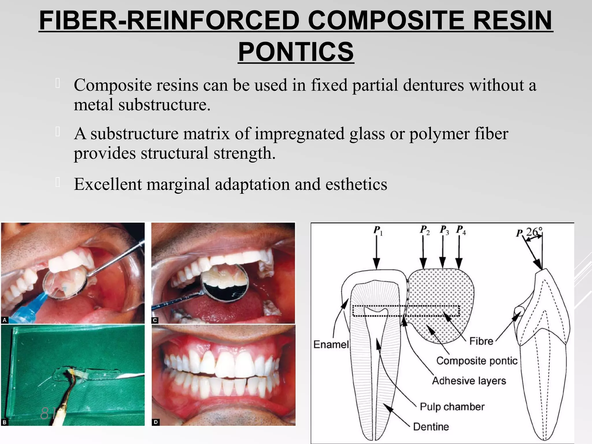 Pontics in Fixed Partial Dentures | PPT