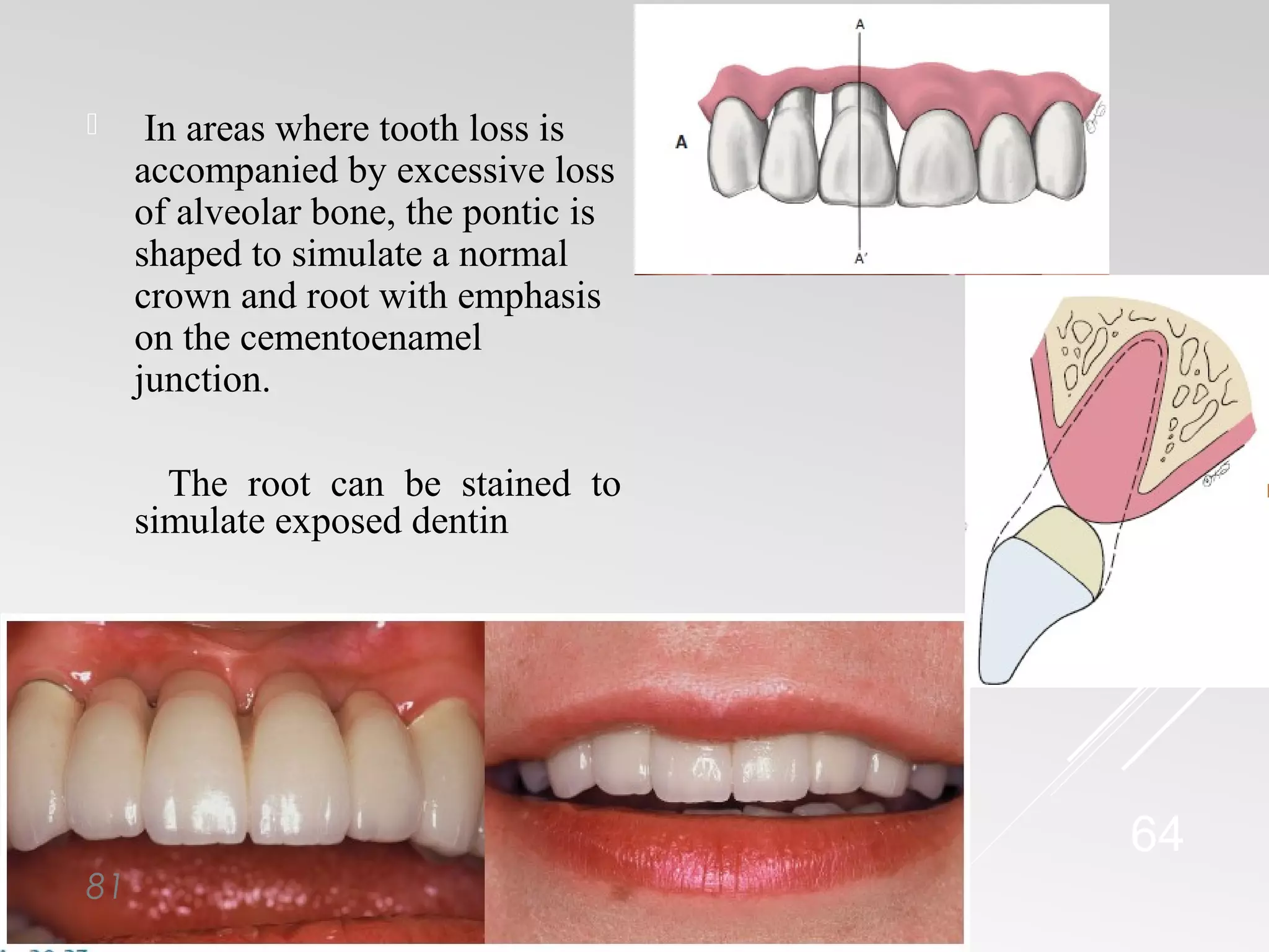 Pontics in Fixed Partial Dentures | PPT