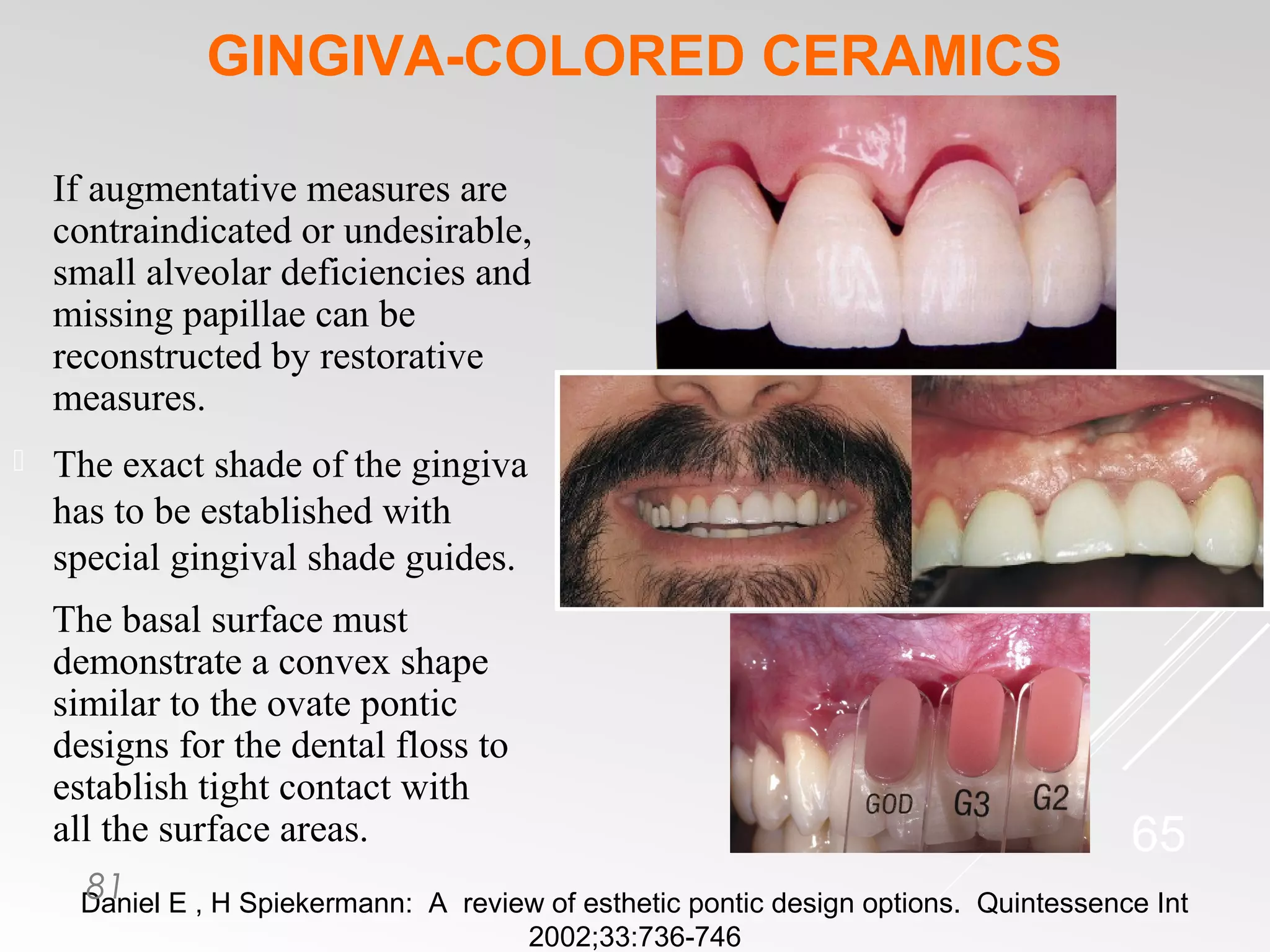 Pontics in Fixed Partial Dentures | PPT