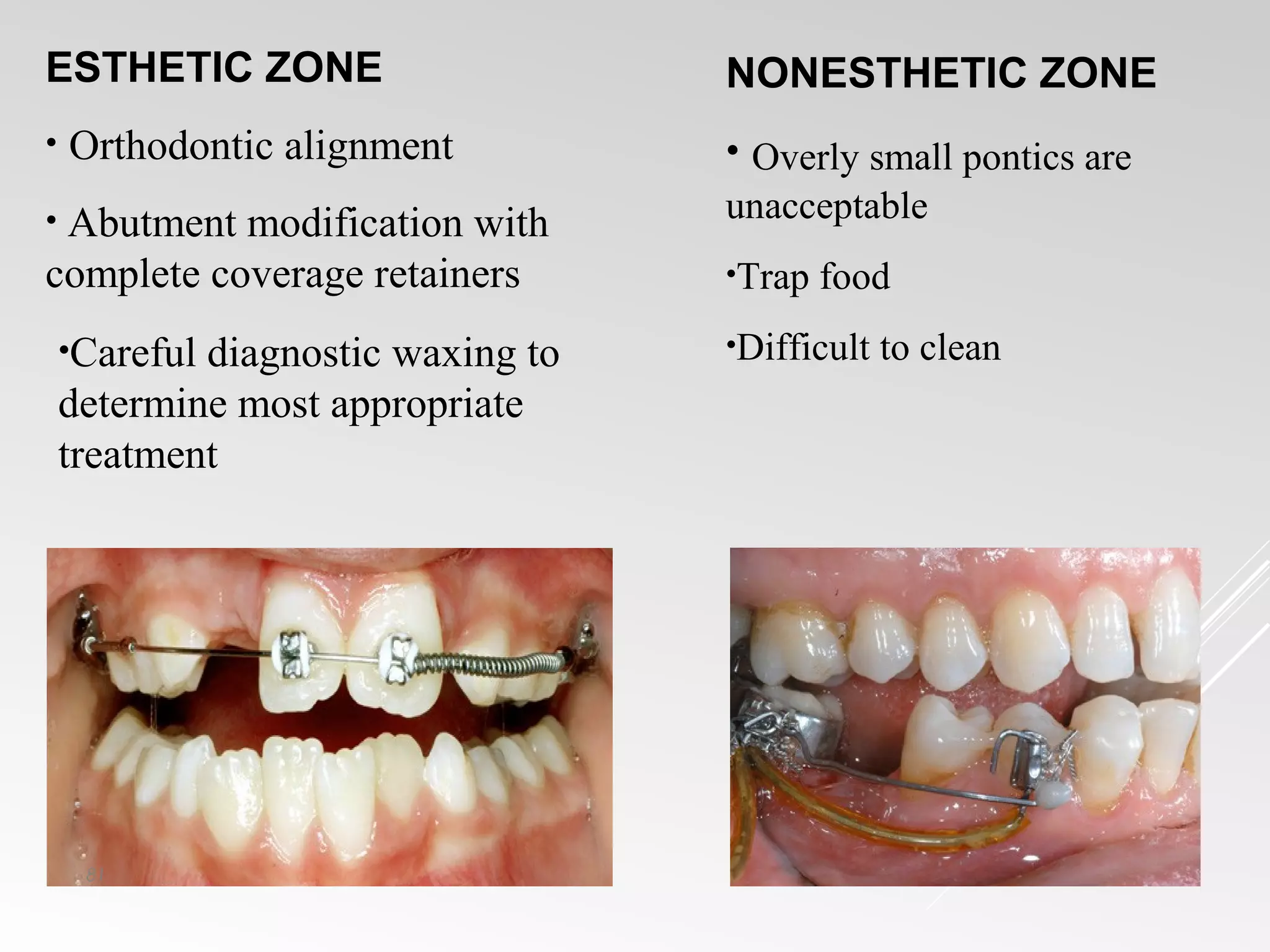 Pontics in Fixed Partial Dentures | PPT