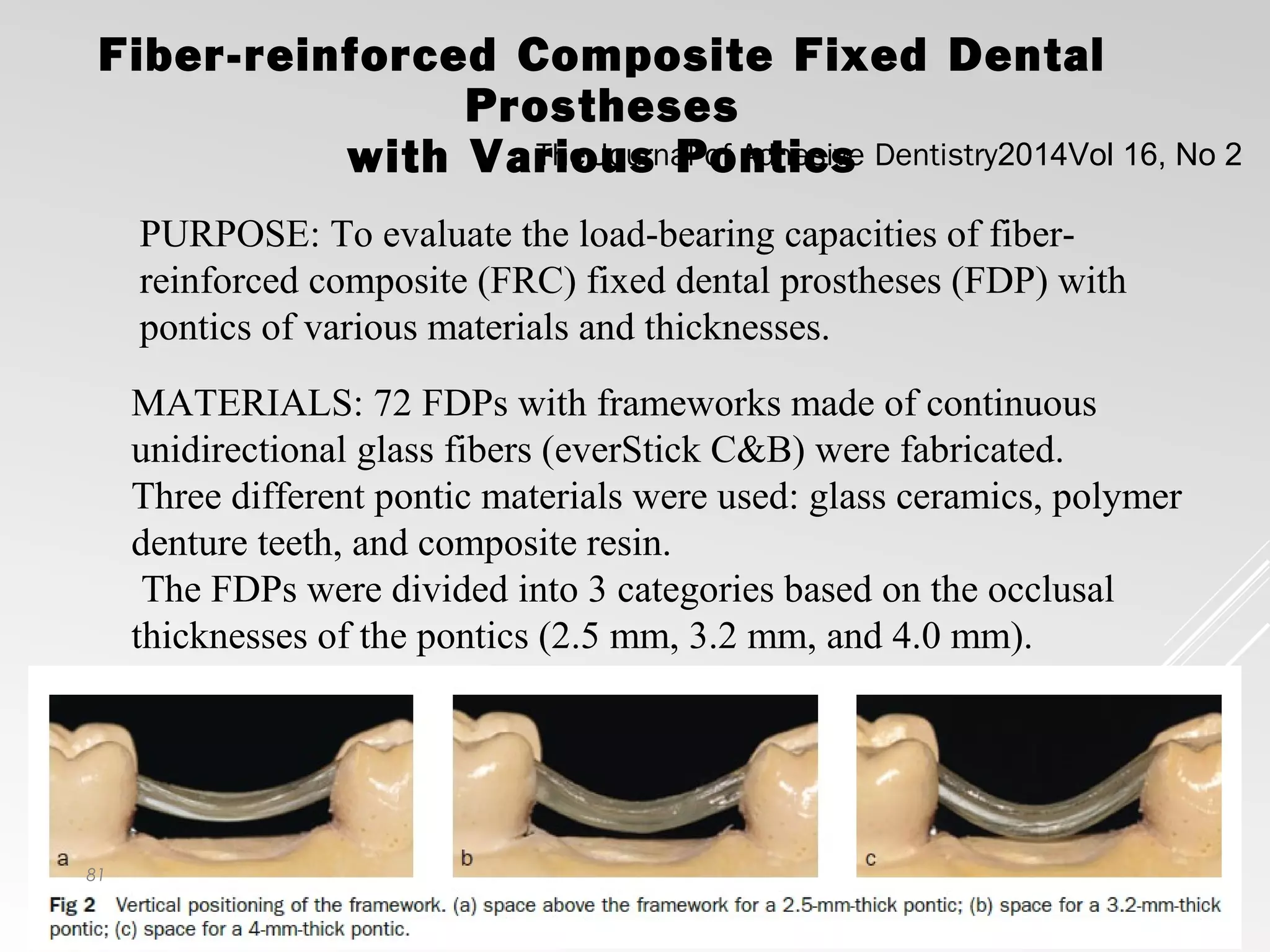 Pontics in Fixed Partial Dentures | PPT