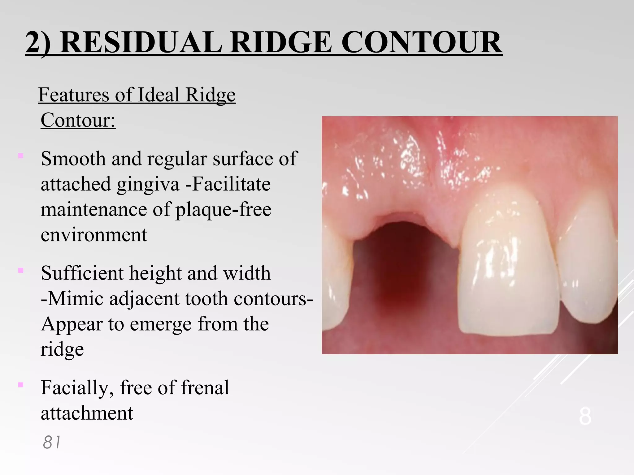 Pontics in Fixed Partial Dentures | PPT