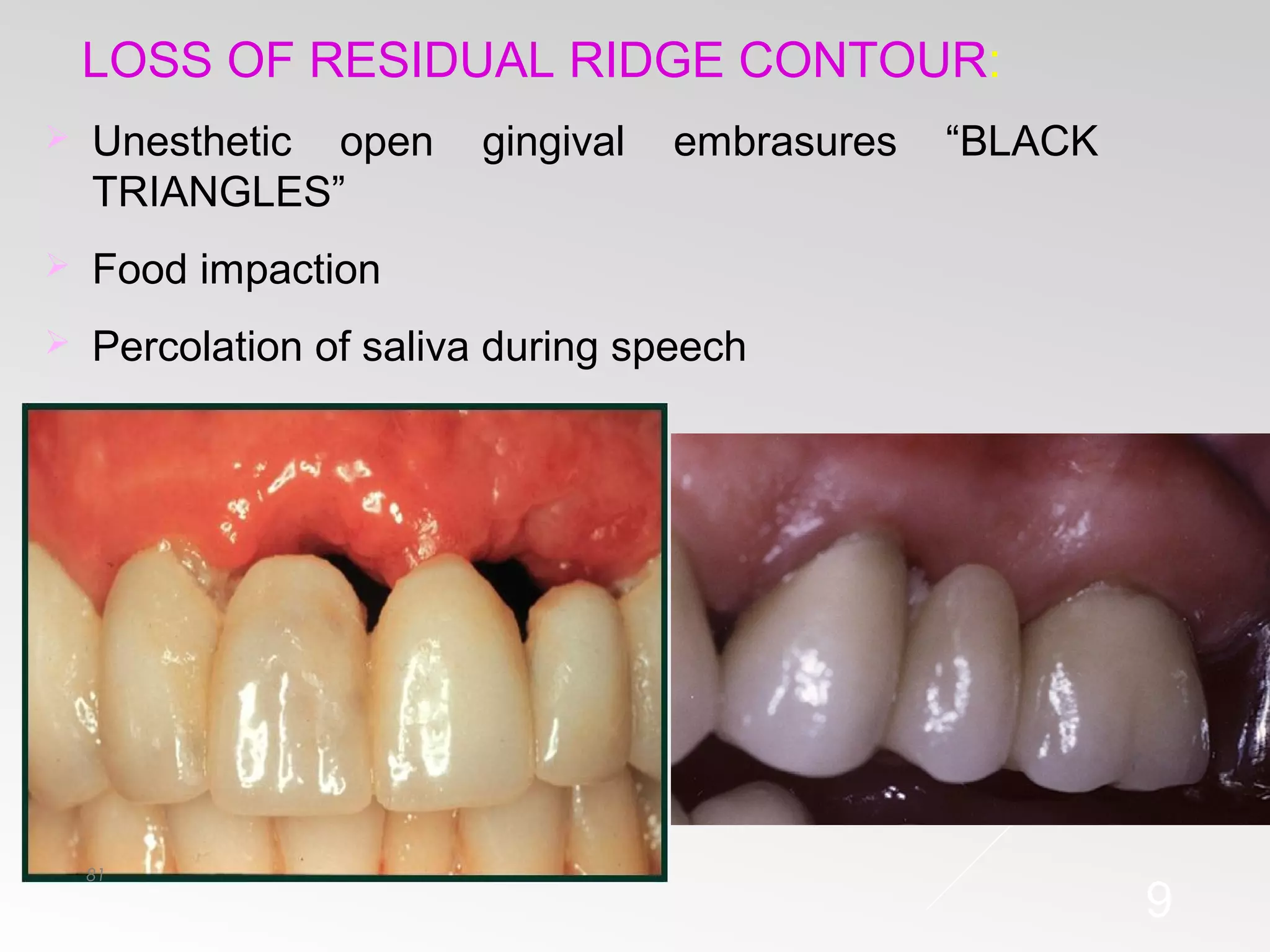 Pontics in Fixed Partial Dentures | PPT
