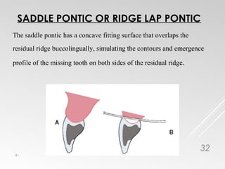 Pontics in Fixed Partial Dentures | PPT