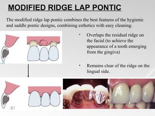 Pontics in Fixed Partial Dentures | PPT
