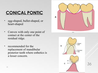 Pontics in Fixed Partial Dentures | PPT