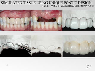 Pontics in Fixed Partial Dentures | PPT
