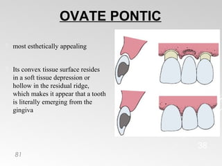 Pontics in Fixed Partial Dentures | PPT