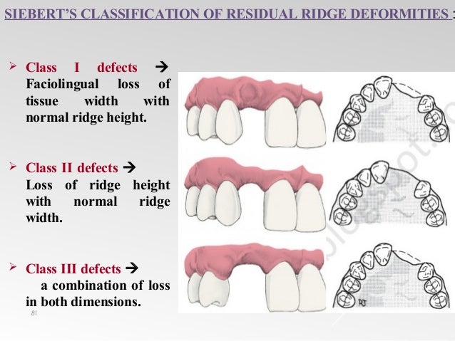 Pontics in Fixed Partial Dentures