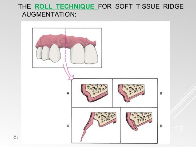 Pontics in Fixed Partial Dentures