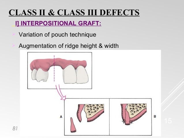 Pontics in Fixed Partial Dentures